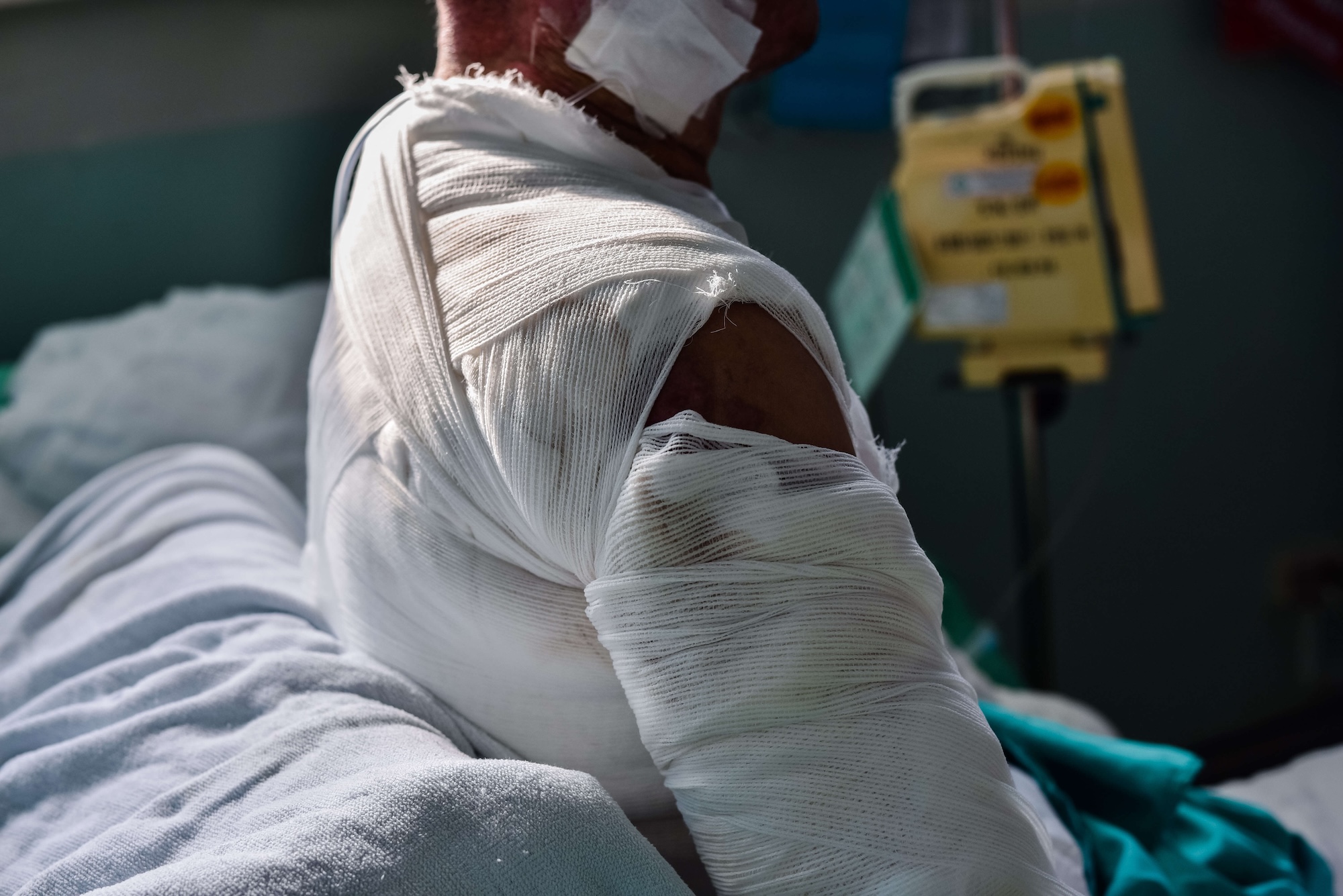Pennsylvania Scarring & Disfigurement Lawyers | Handler, Henning ...